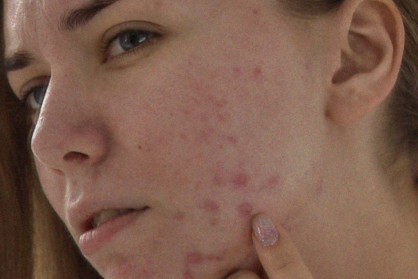My Favourite Acne Treatments - Adapalene (Differin) – Dr Sam's