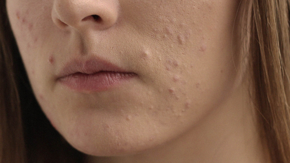 How To Treat Teenage Acne – Dr Sam's