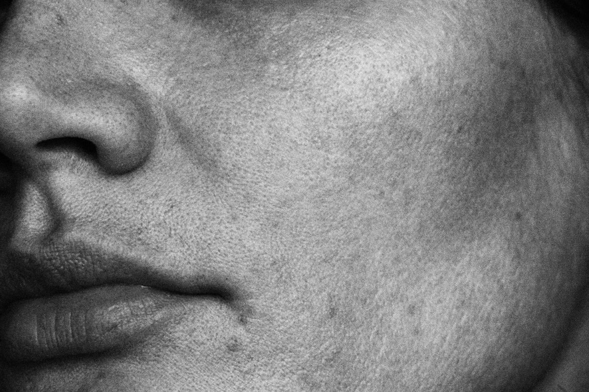 Uneven Skin Texture – Dr Sam's