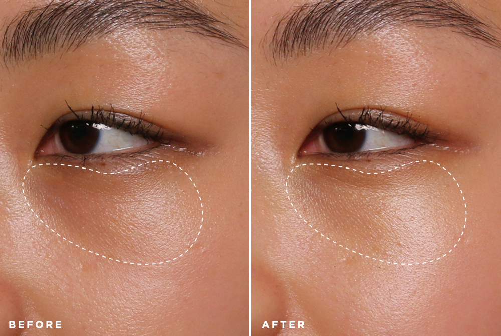 How to Get Rid of Dark Circles: Dermatologist-Approved Guide – Dr Sam's