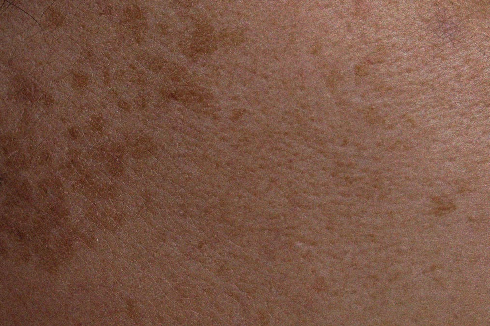 Why Blue Light Matters in Hyperpigmentation – Dr Sam's