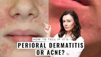 How To Treat Perioral Dermatitis Effectively – Dr Sam's