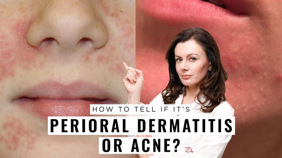 How To Treat Perioral Dermatitis Effectively – Dr Sam's